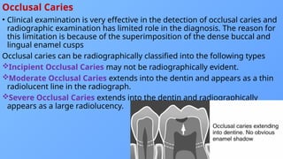 Dental caries and radiographic assessment of restoration.pptx