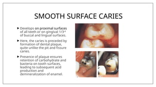 DENTAL CARIES PRESENTATION DOWNLOAD.pptx
