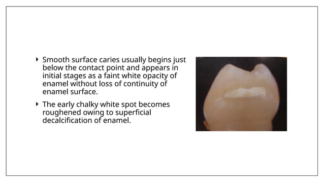 DENTAL CARIES PRESENTATION DOWNLOAD.pptx