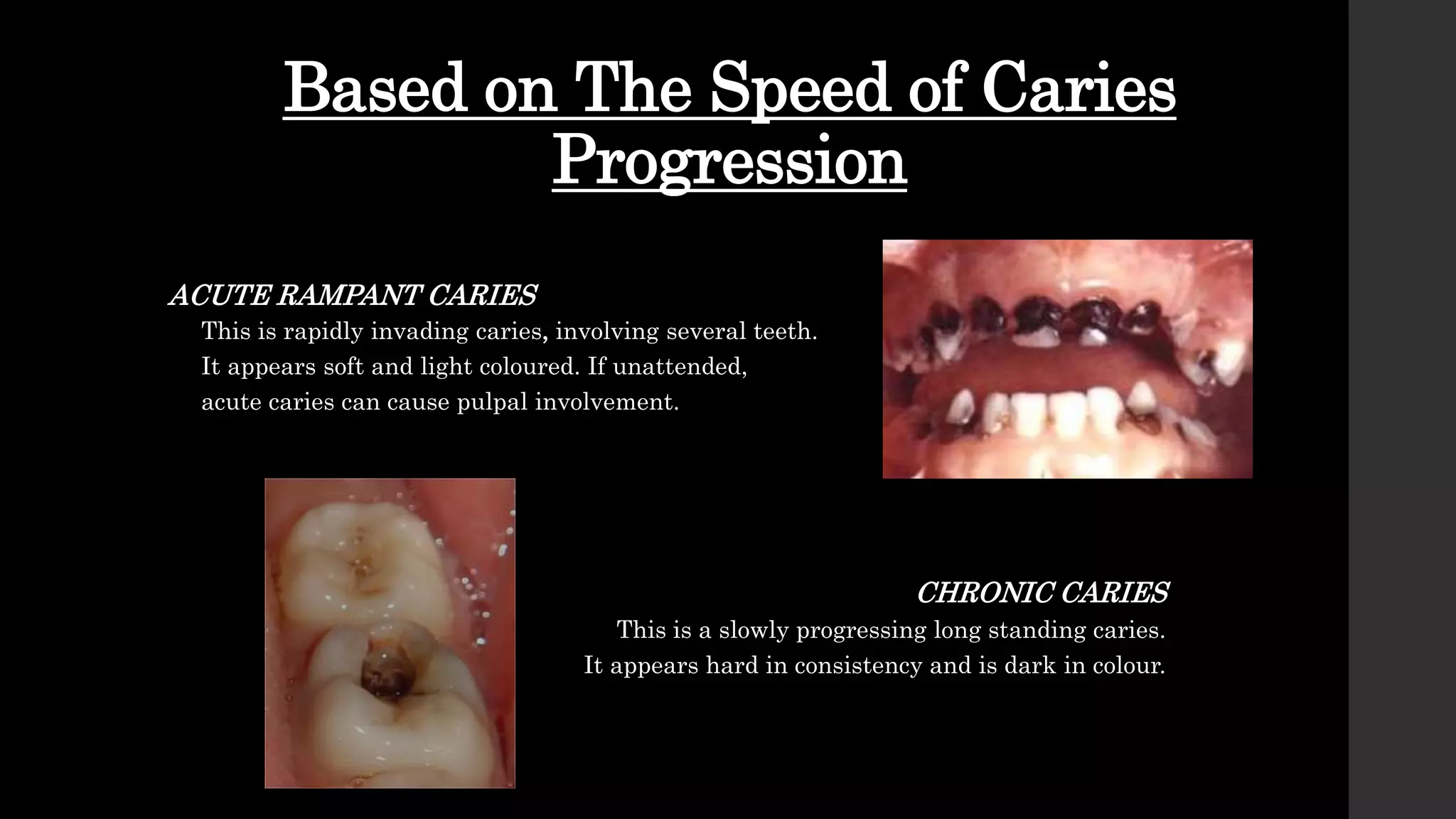Dental Caries Classification And Microbiology Pptx