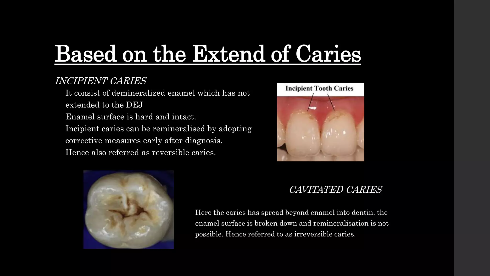 Dental Caries classification & Microbiology | PPTX