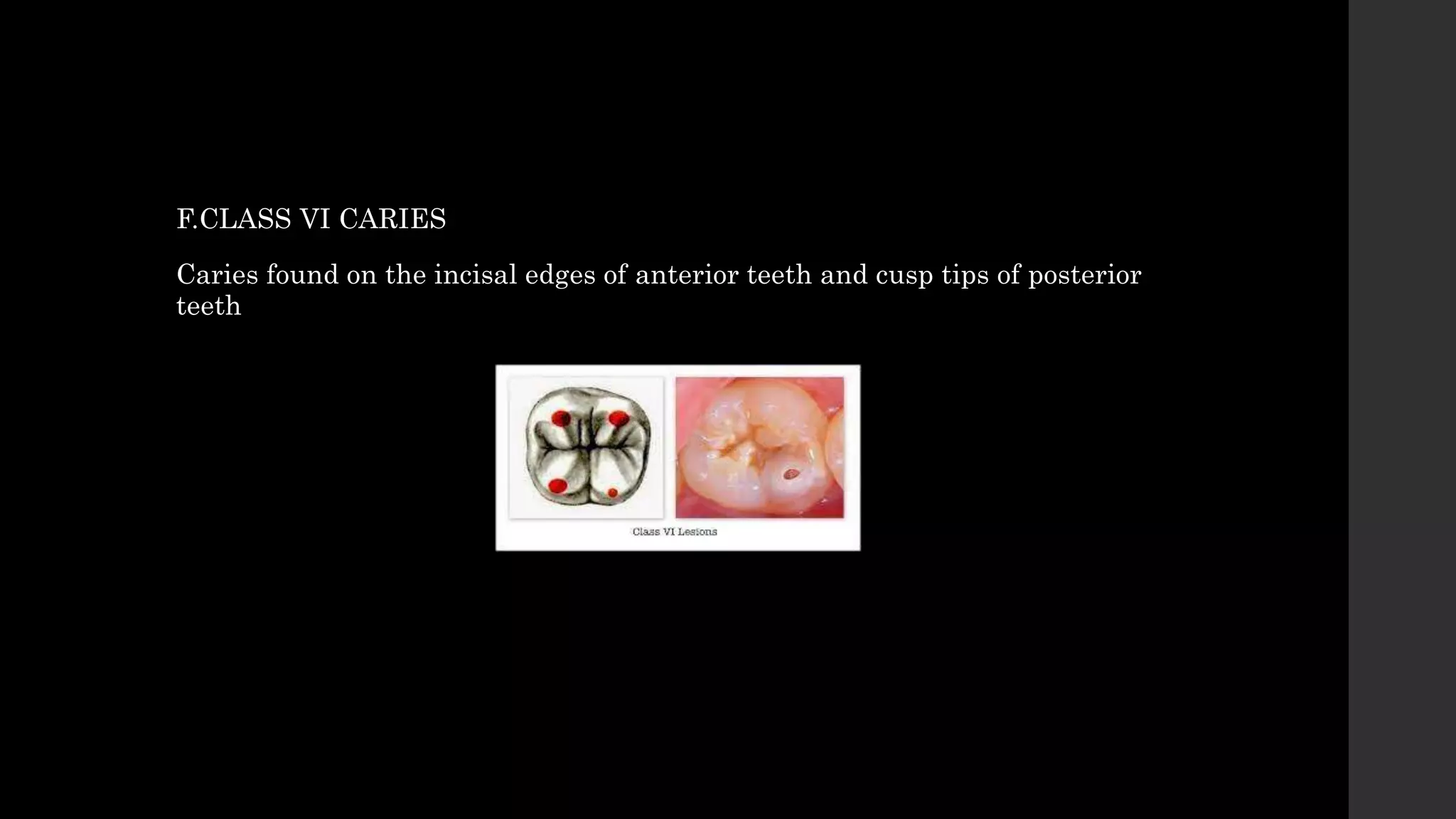 Dental Caries classification & Microbiology | PPTX