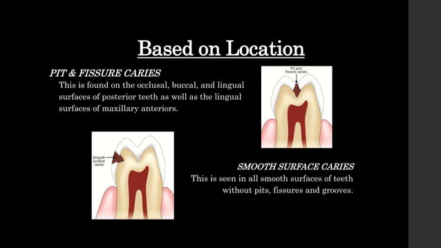 Dental Caries classification & Microbiology | PPTX