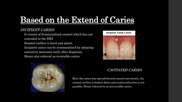Dental Caries classification & Microbiology | PPTX