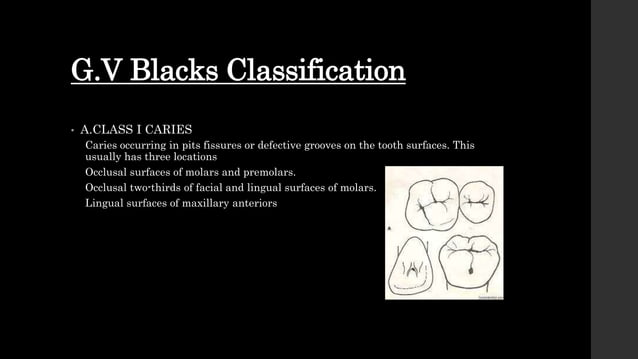 Dental Caries classification & Microbiology | PPTX