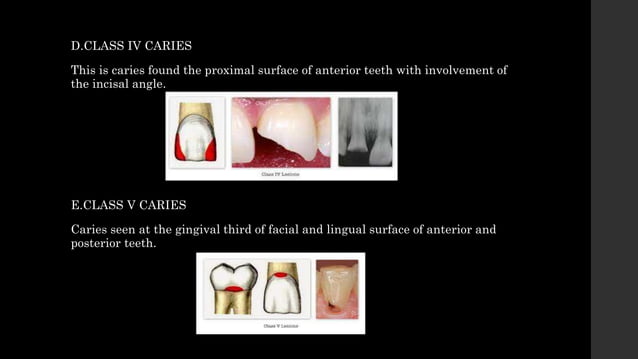 Dental Caries classification & Microbiology | PPTX