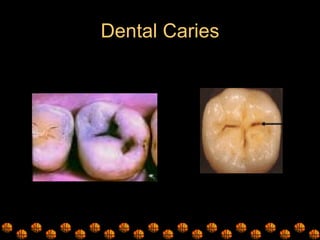 Dental caries | PPT