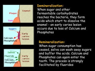 Dental_caries_hisopathology.pptx dental caries | PPTX