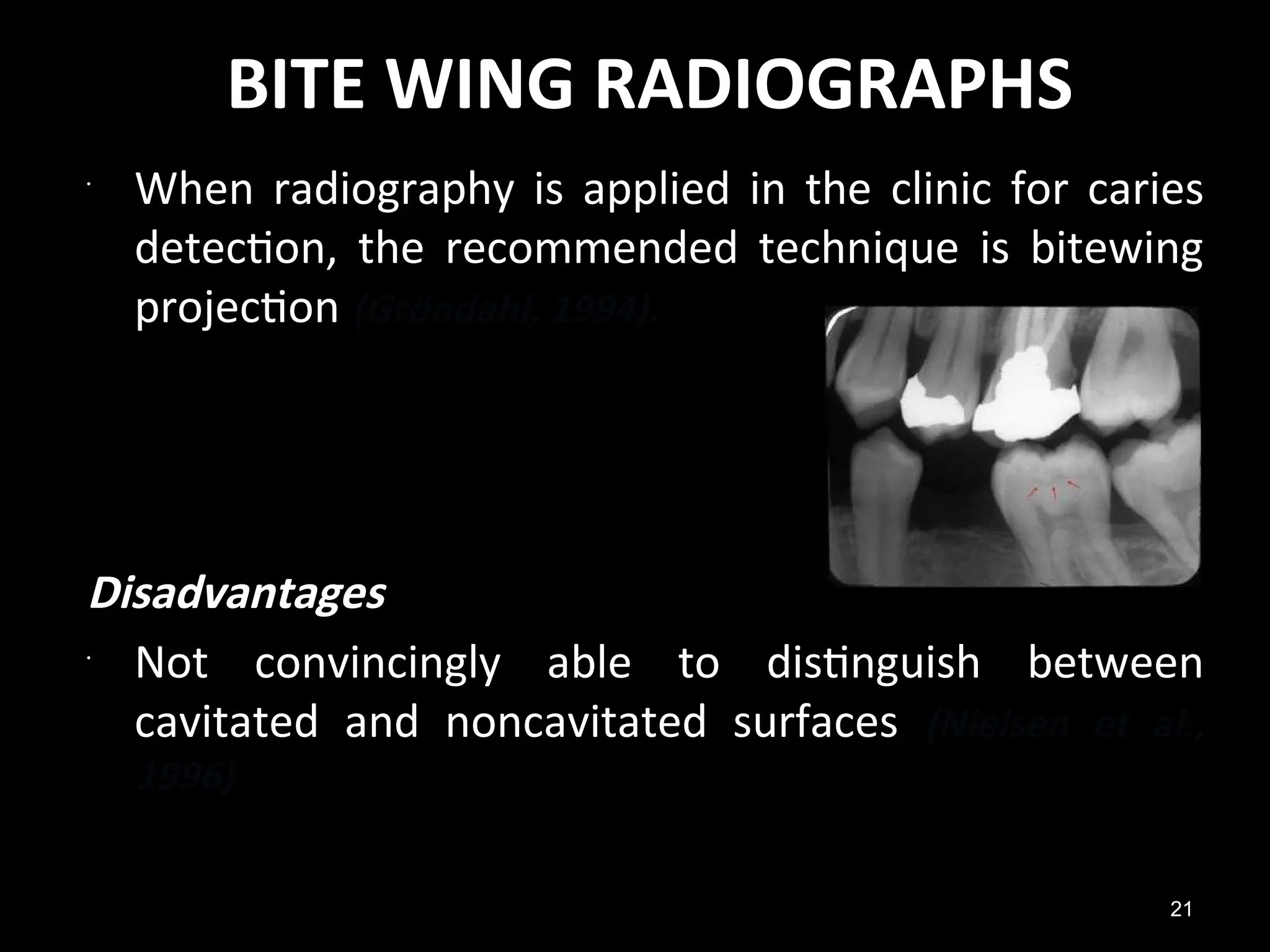 Dental_caries_hisopathologyanddiagnosis.ppt