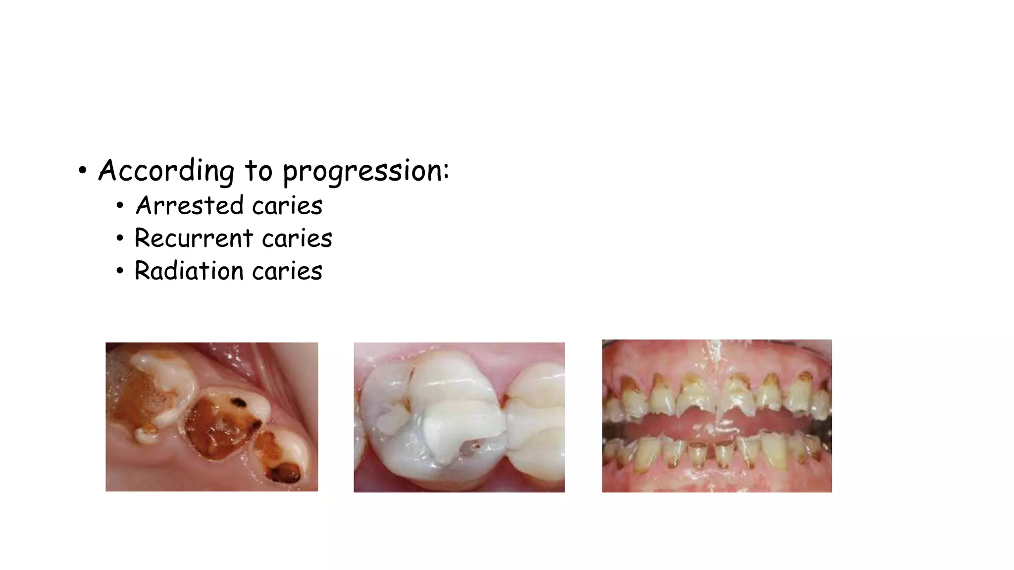 Dental caries , its etiology | PPTX