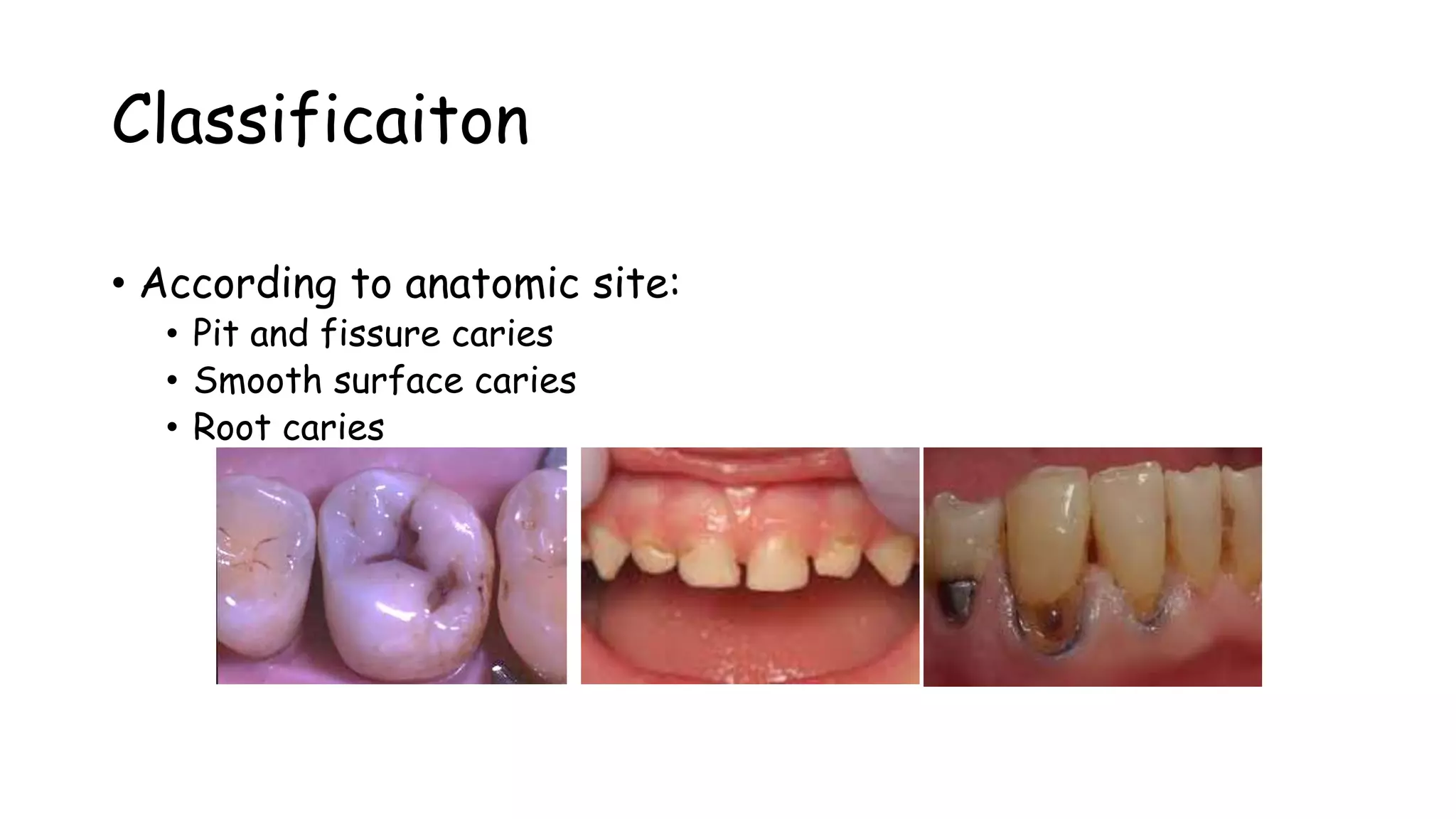 Dental caries , its etiology | PPTX