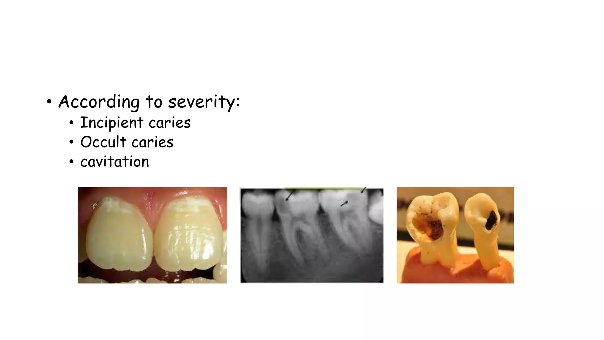 Dental caries , its etiology | PPTX