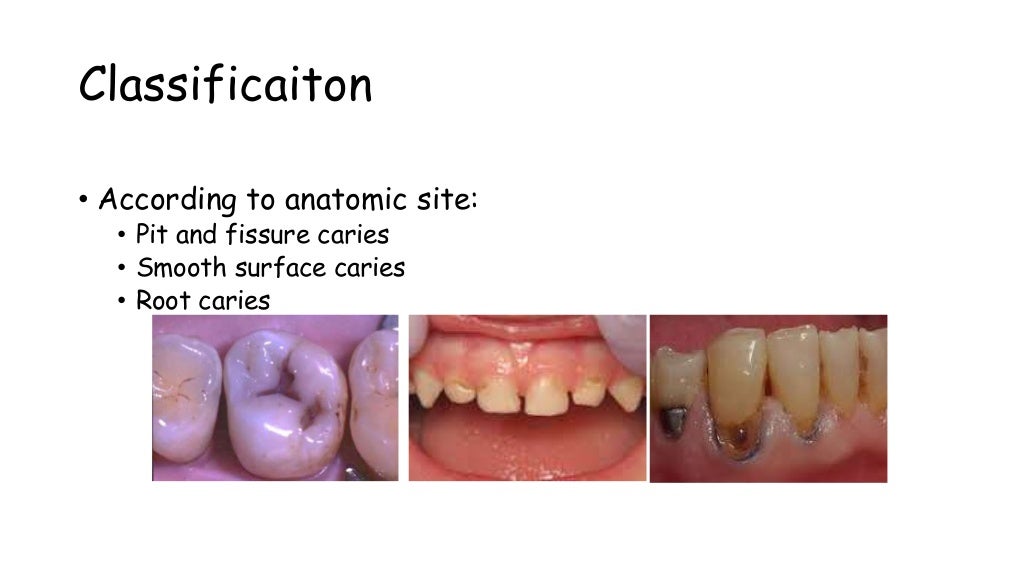 Dental caries , its etiology