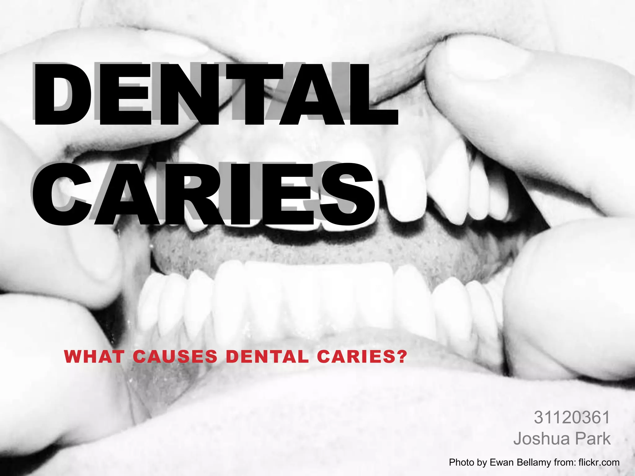 Dental caries | PPT