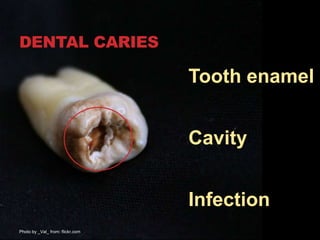 Dental caries | PPT