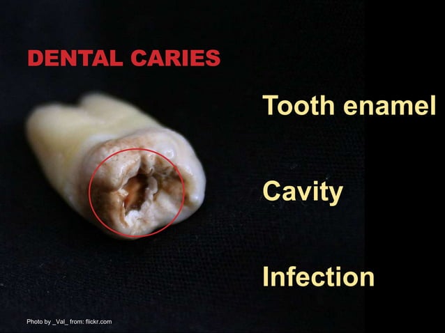 Dental caries | PPT