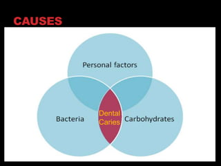 Dental caries | PPT