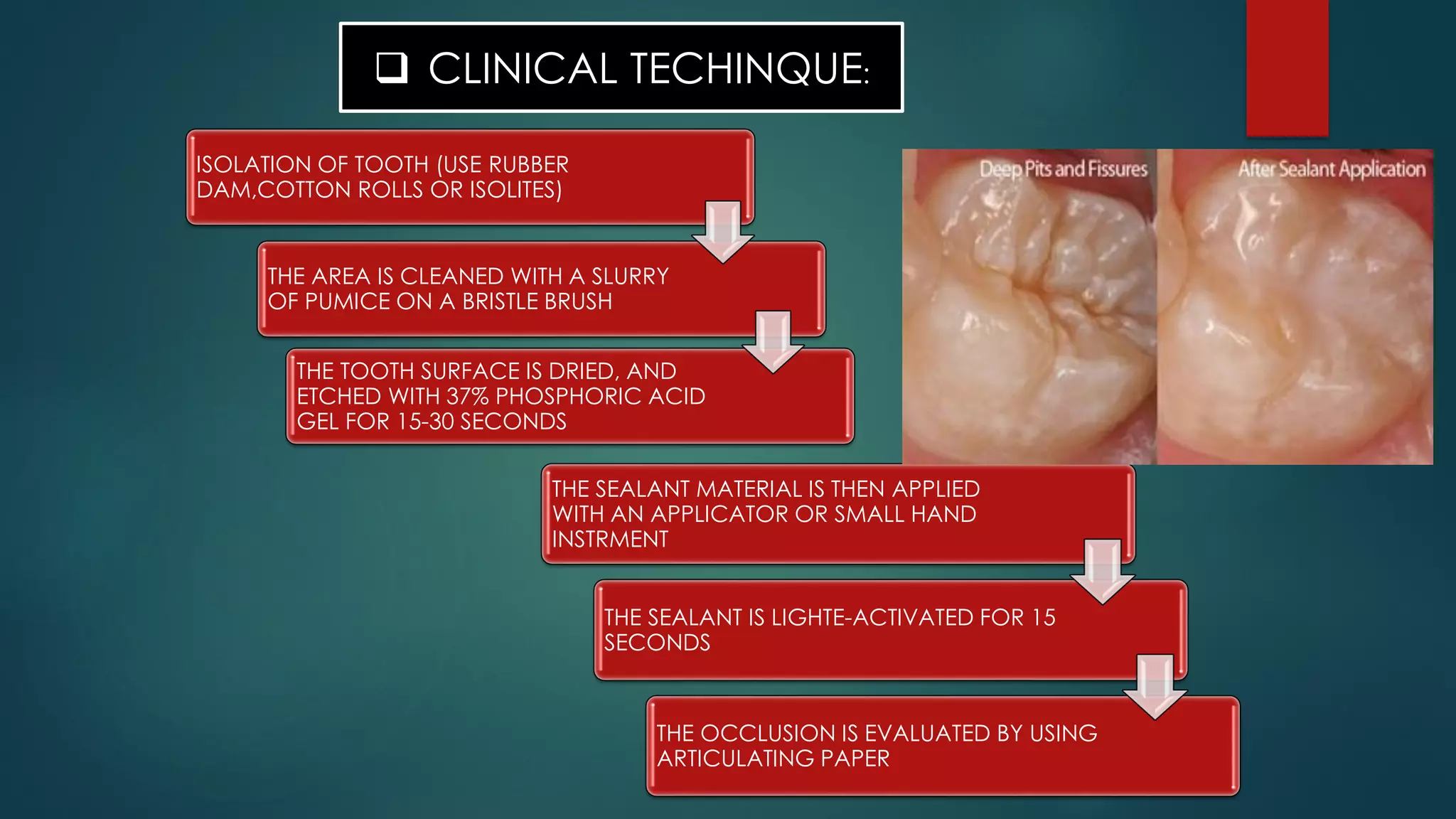 Dental caries and management | PDF