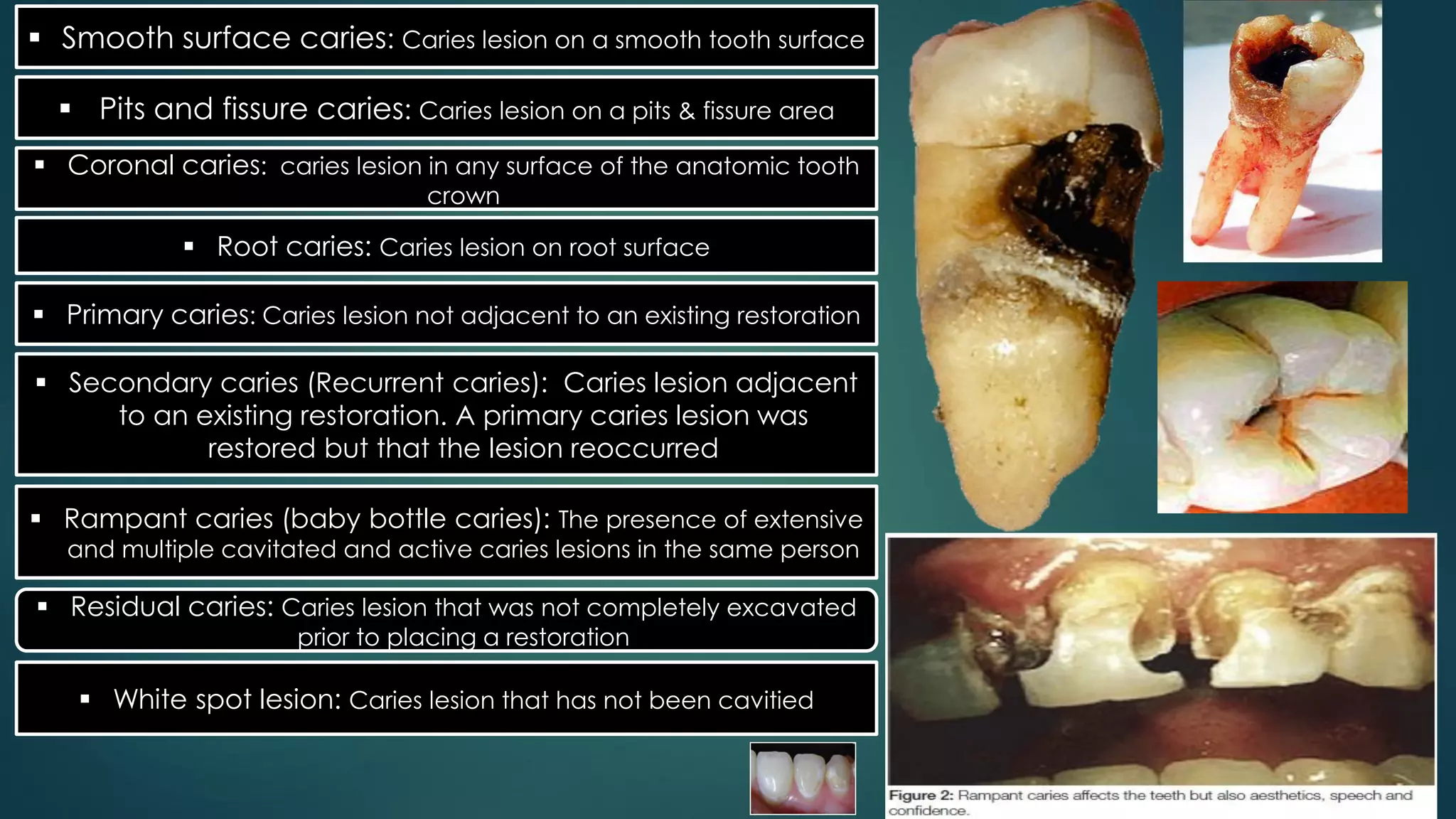 Dental caries and management | PDF