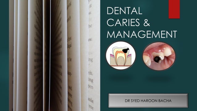 Dental caries and management | PDF