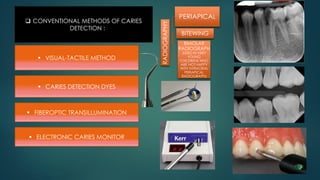 Dental caries and management | PDF
