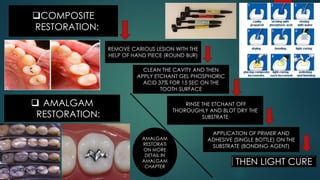 Dental caries and management | PDF
