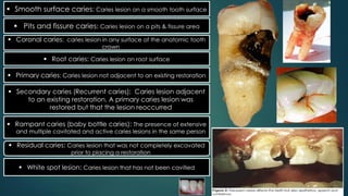 Dental caries and management | PDF