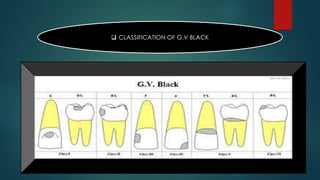 Dental caries and management | PDF