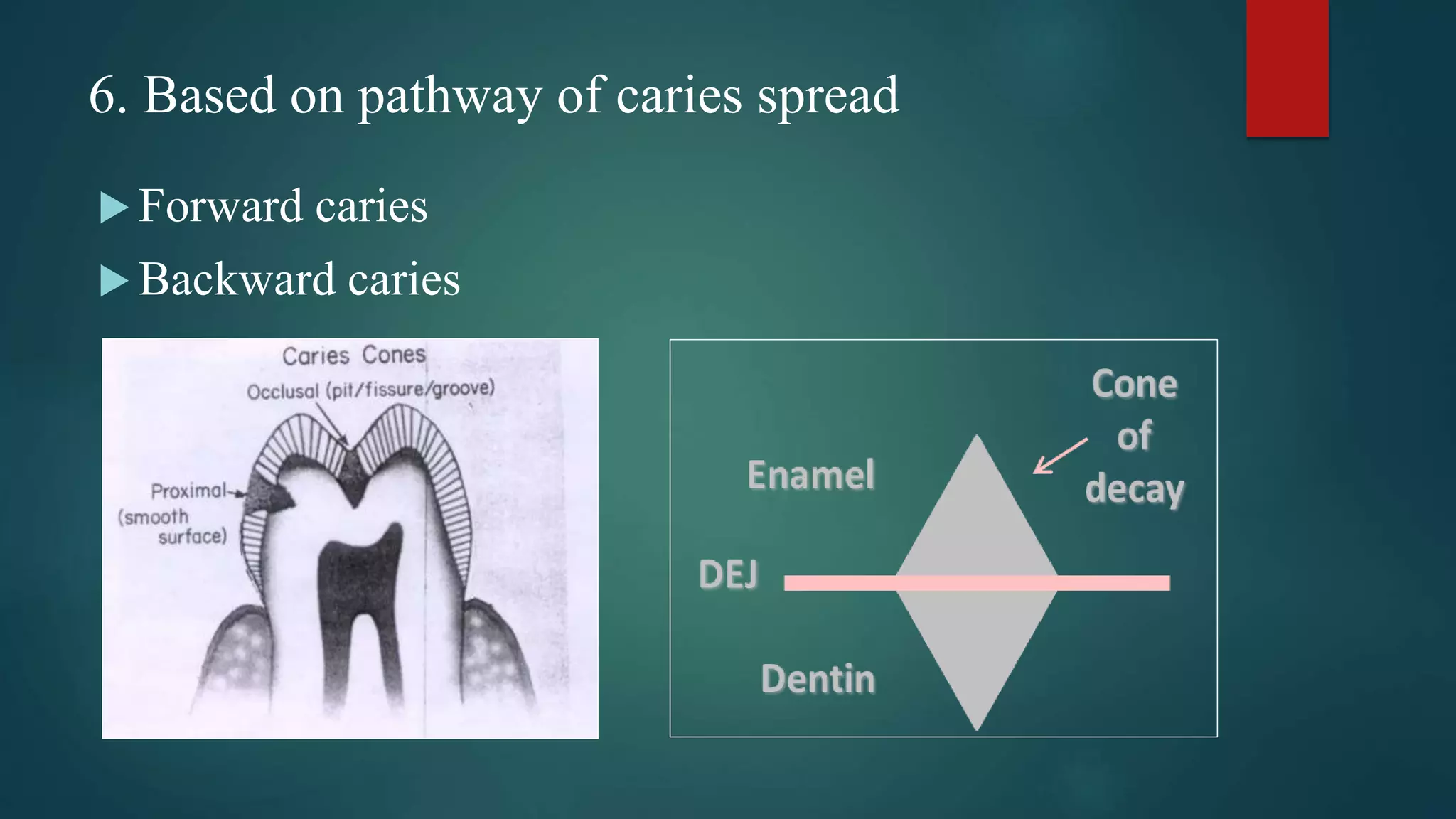 DENTAL CARIES | PPTX