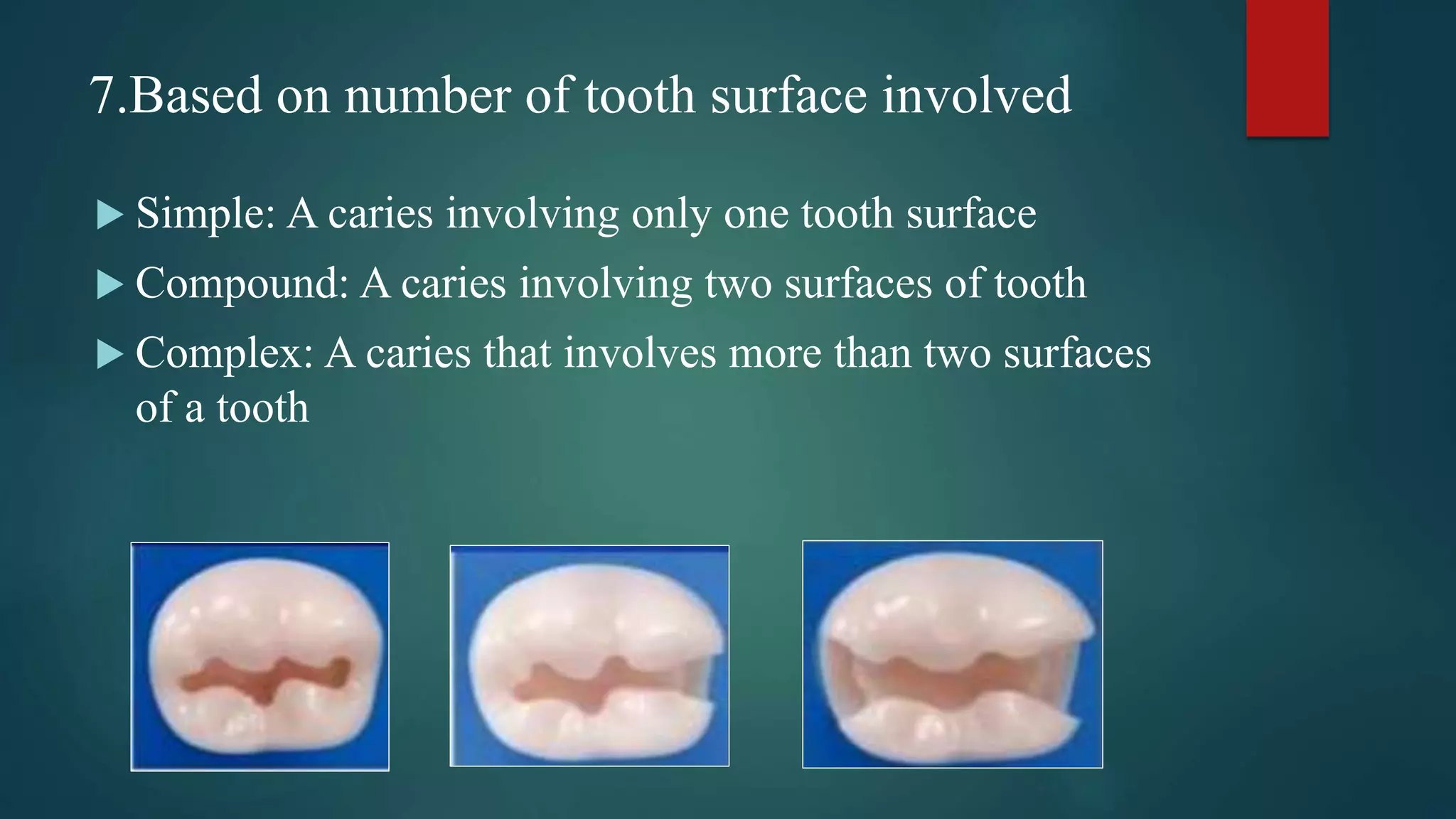 DENTAL CARIES | PPTX