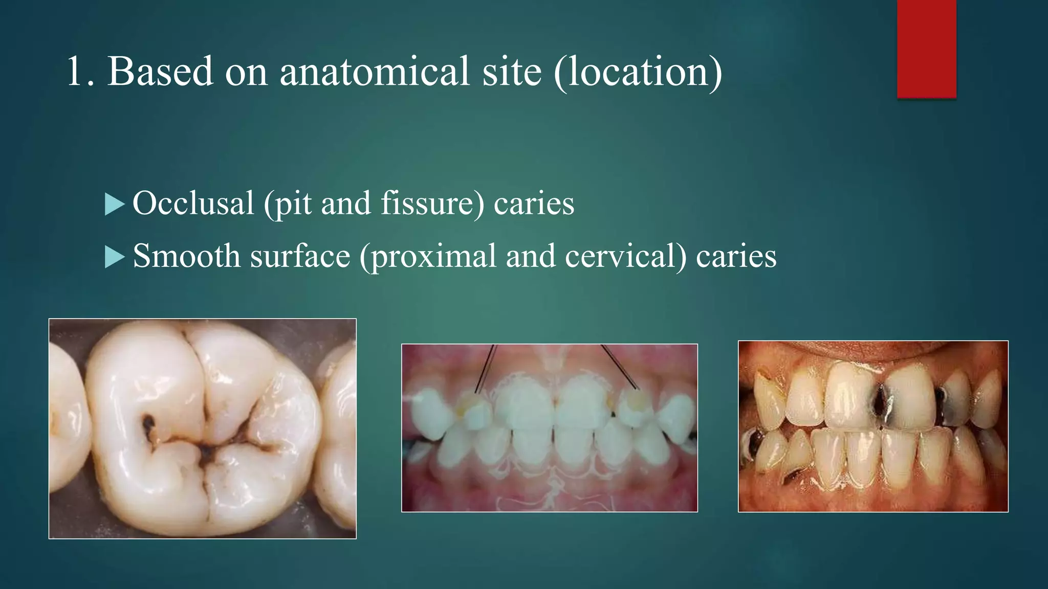 DENTAL CARIES | PPTX