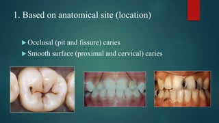 DENTAL CARIES | PPTX