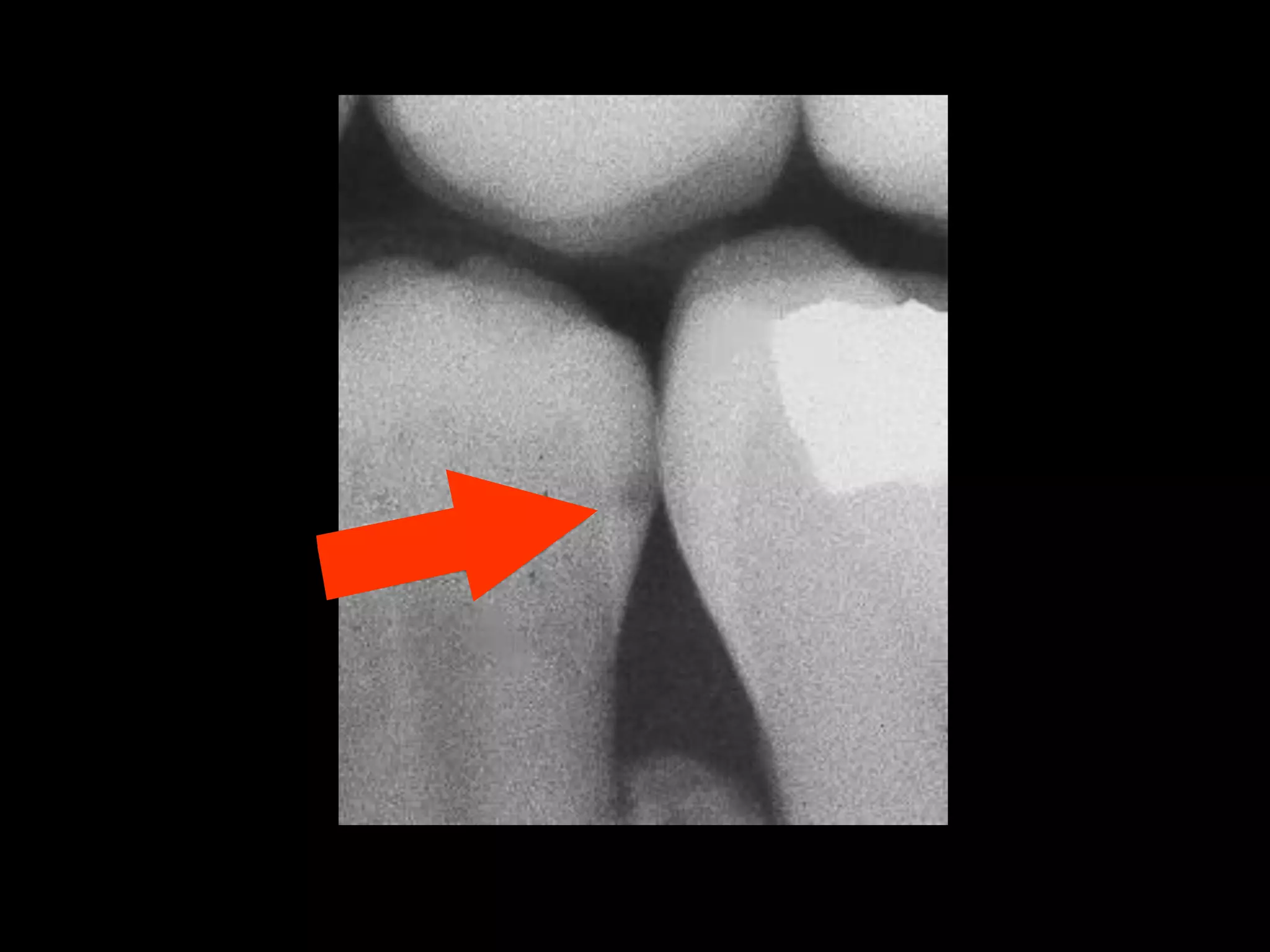 Radiographic Diagnosis of Dental Caries | PDF