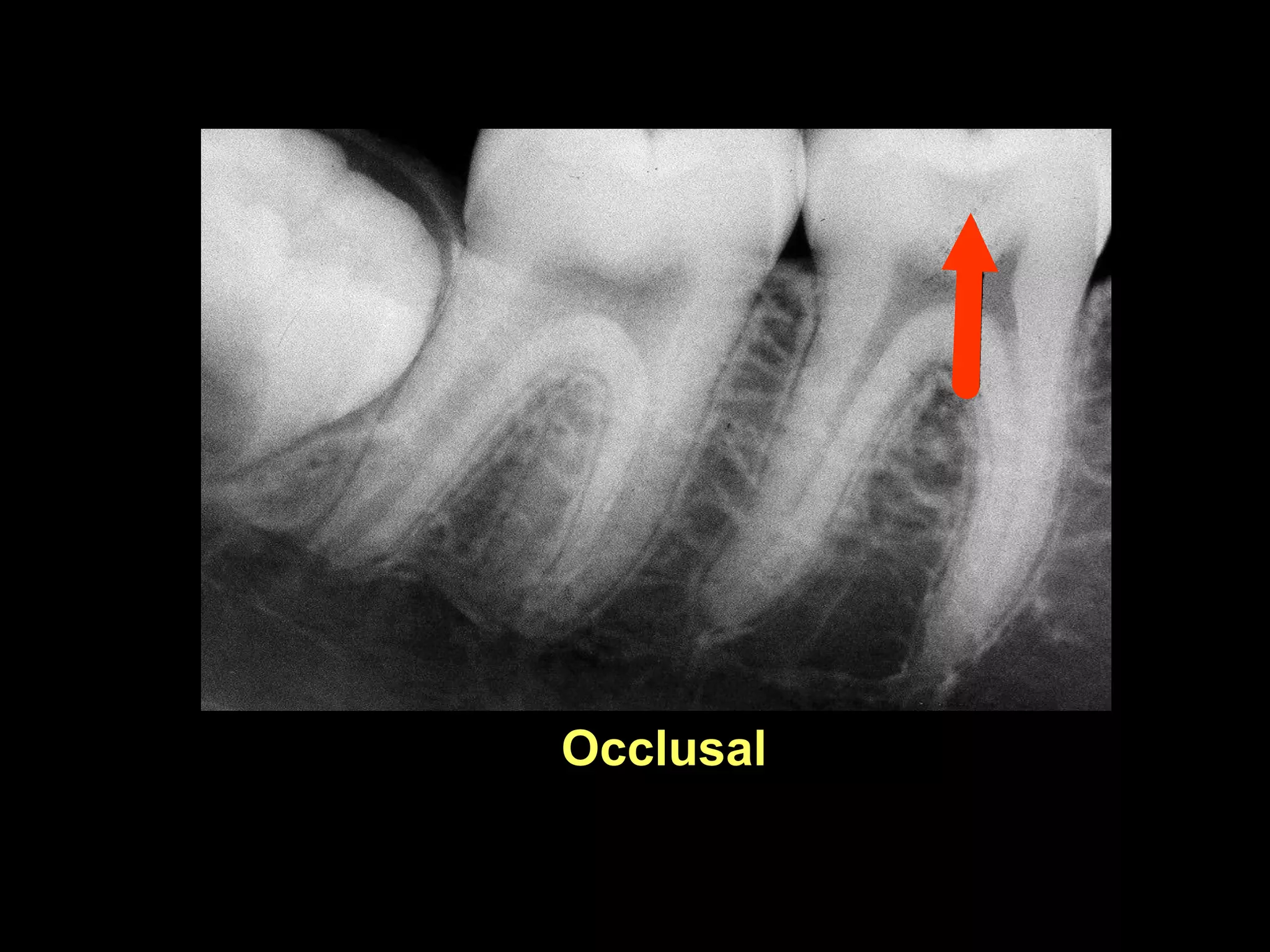 Radiographic Diagnosis of Dental Caries | PDF
