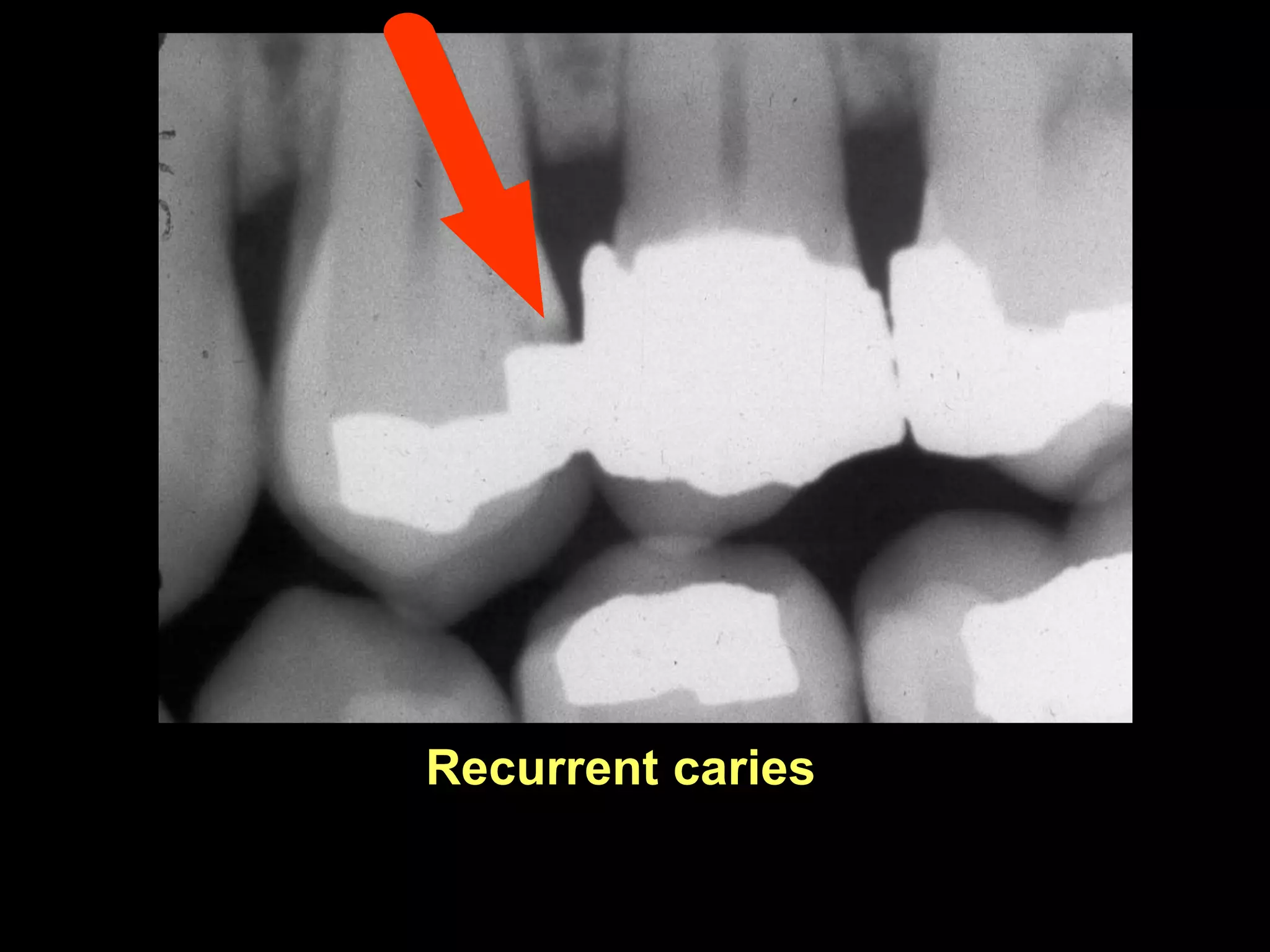 Radiographic Diagnosis of Dental Caries | PDF