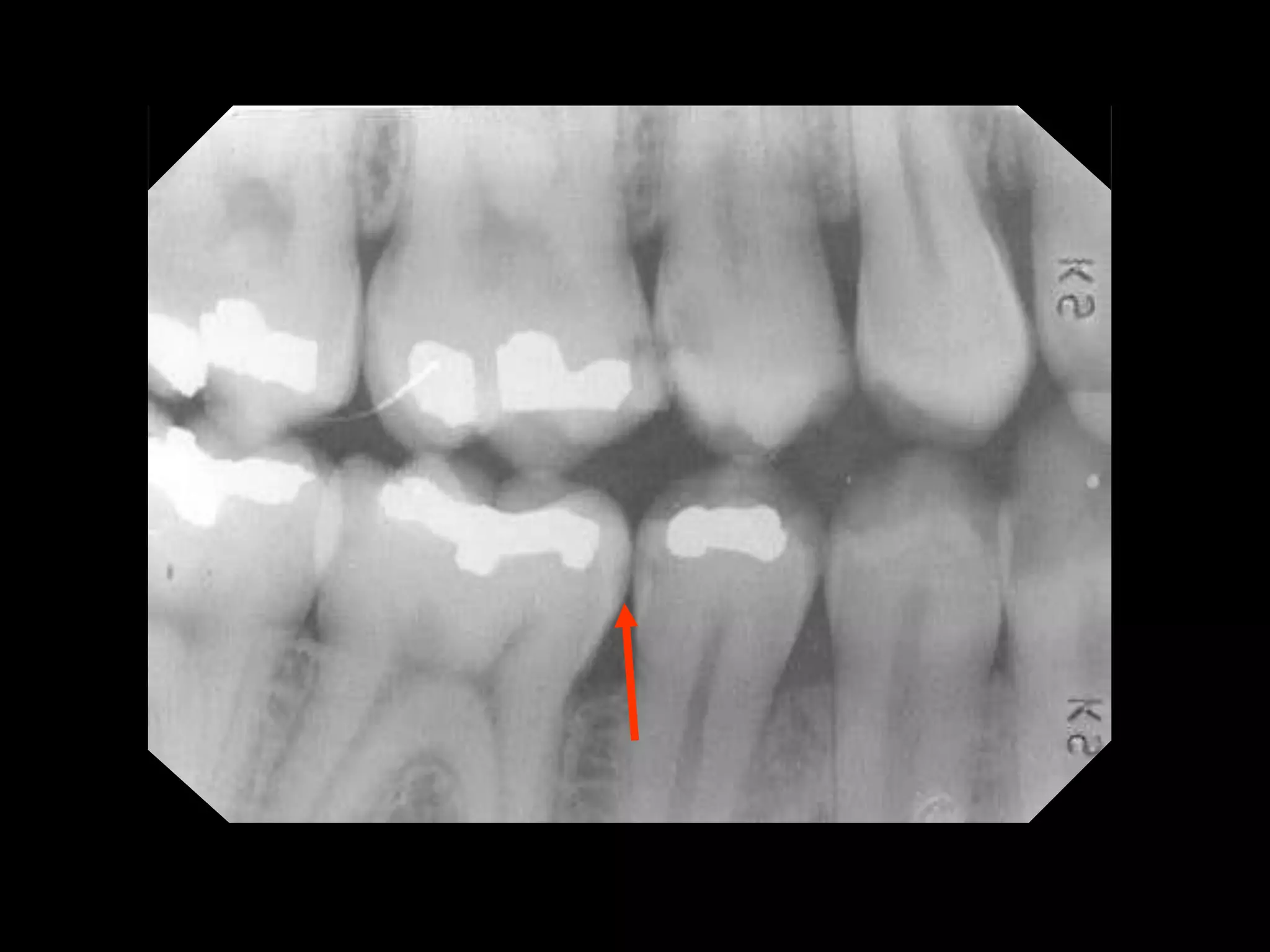 Radiographic Diagnosis of Dental Caries | PDF