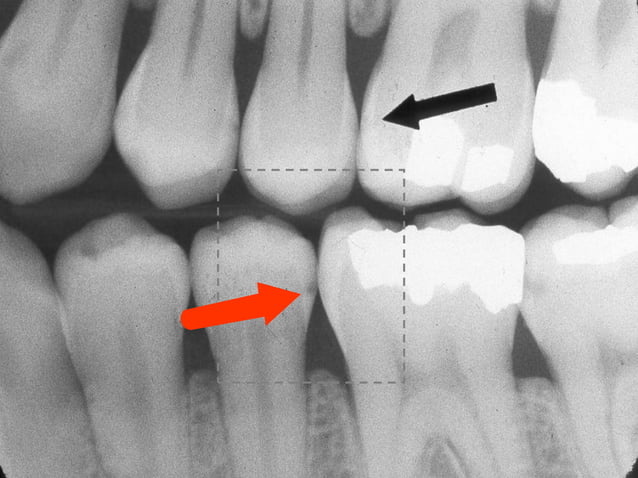 Radiographic Diagnosis of Dental Caries | PDF