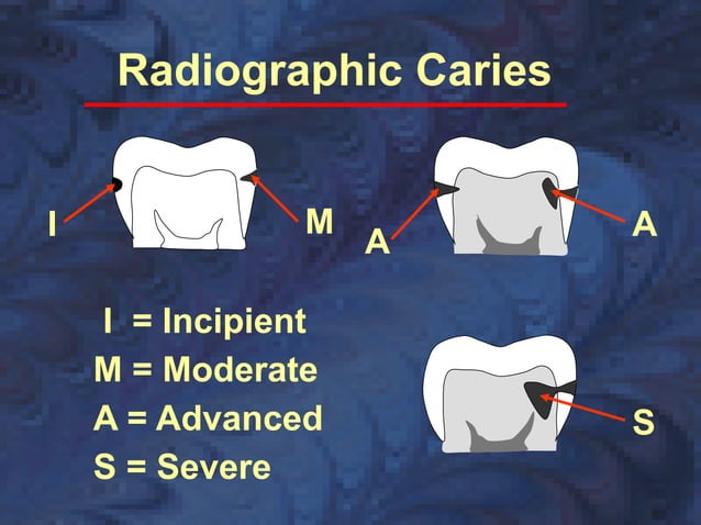 Radiographic Diagnosis of Dental Caries | PDF