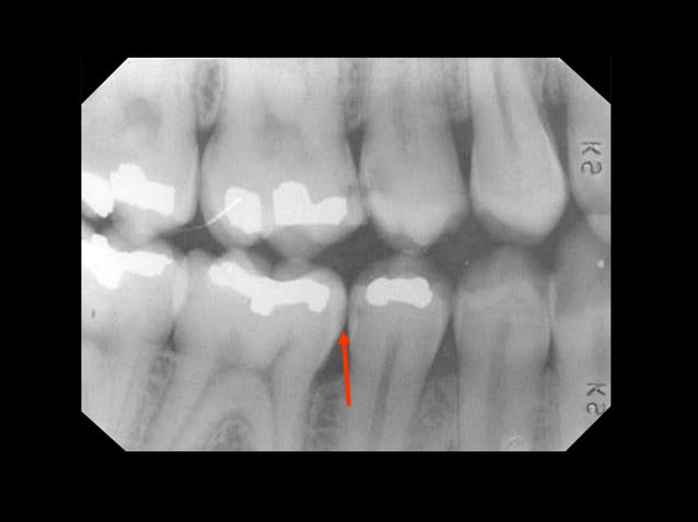 Radiographic Diagnosis of Dental Caries