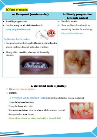 Dental Caries part one oral pathology one | PDF
