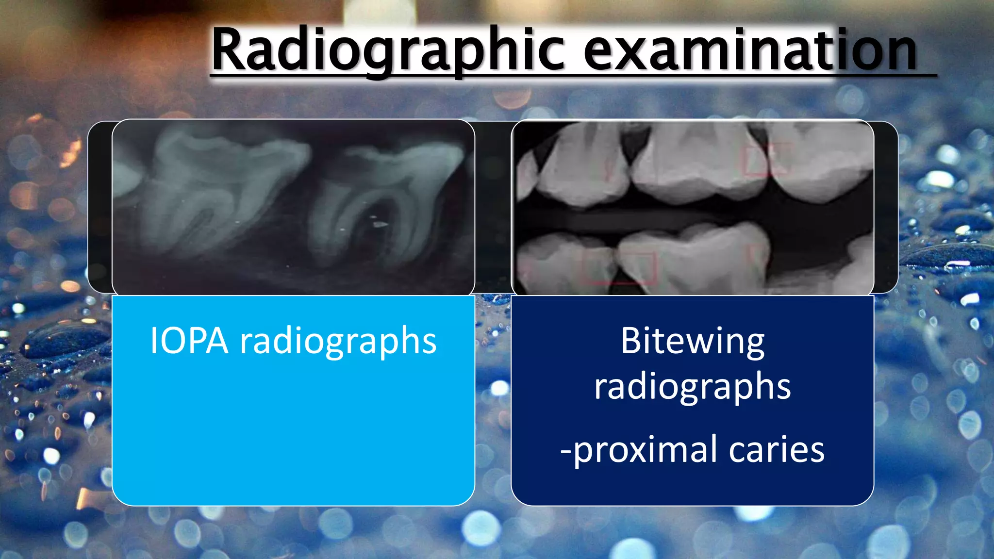 Diagnosis & treatment of Dental caries | PPTX