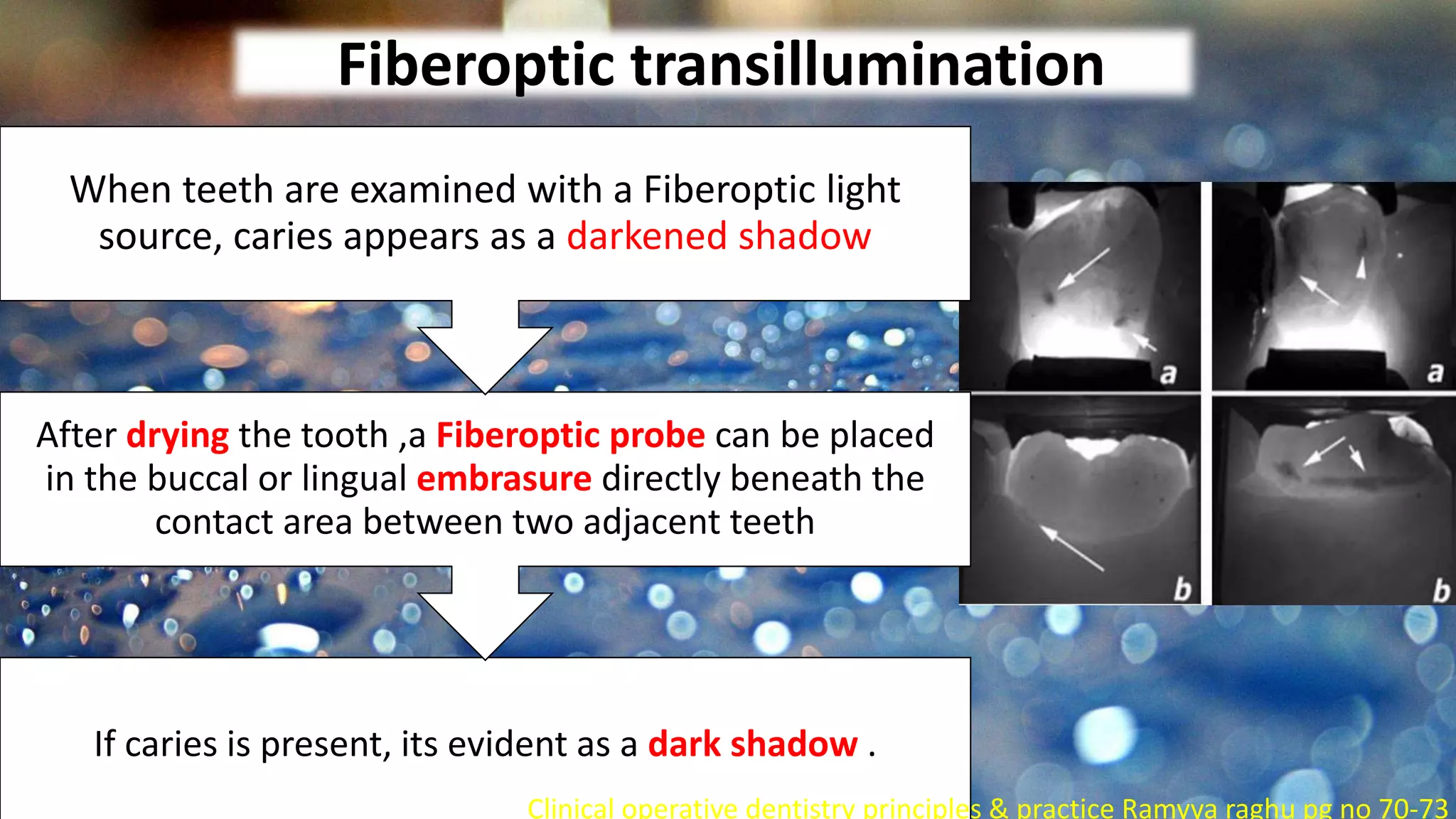 Diagnosis & treatment of Dental caries | PPTX