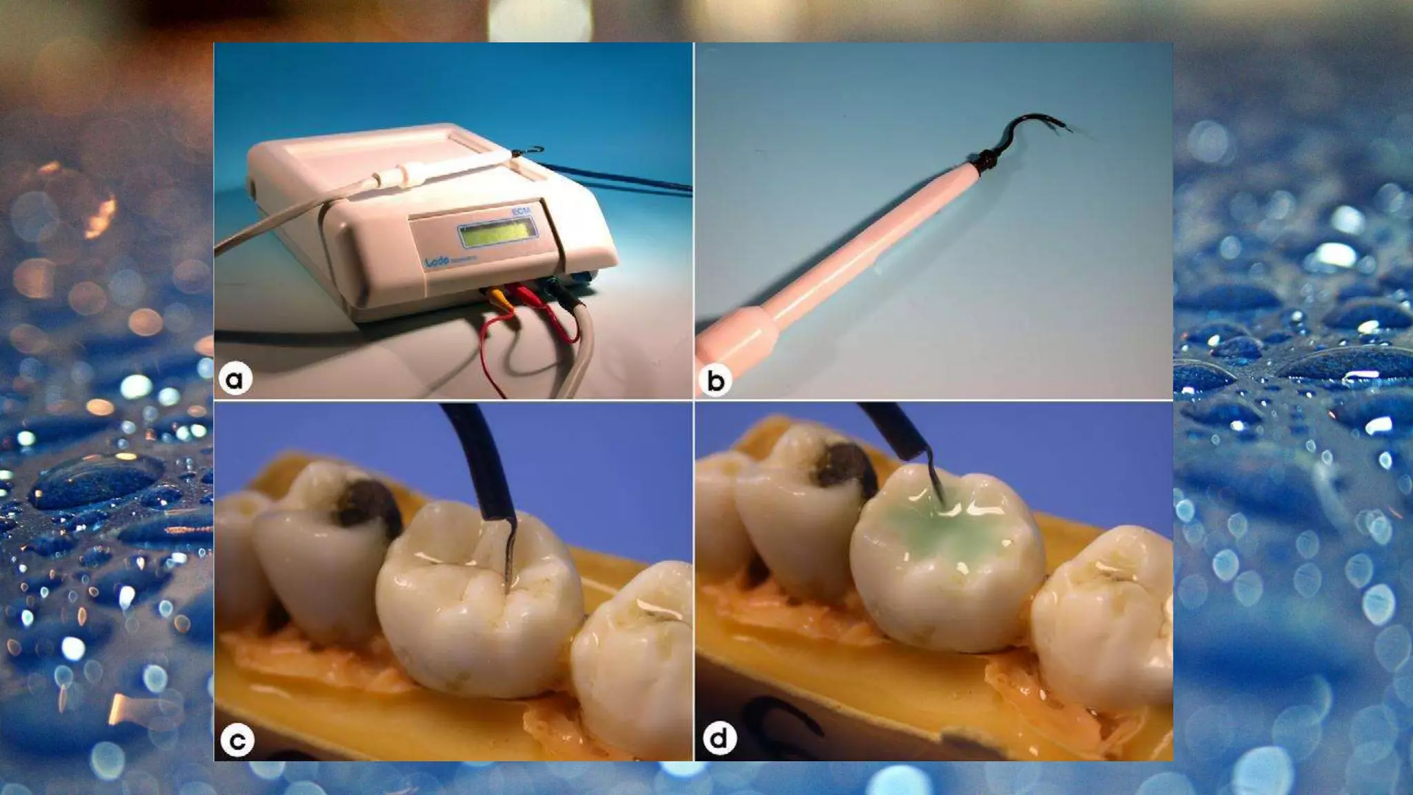 Diagnosis & treatment of Dental caries | PPTX