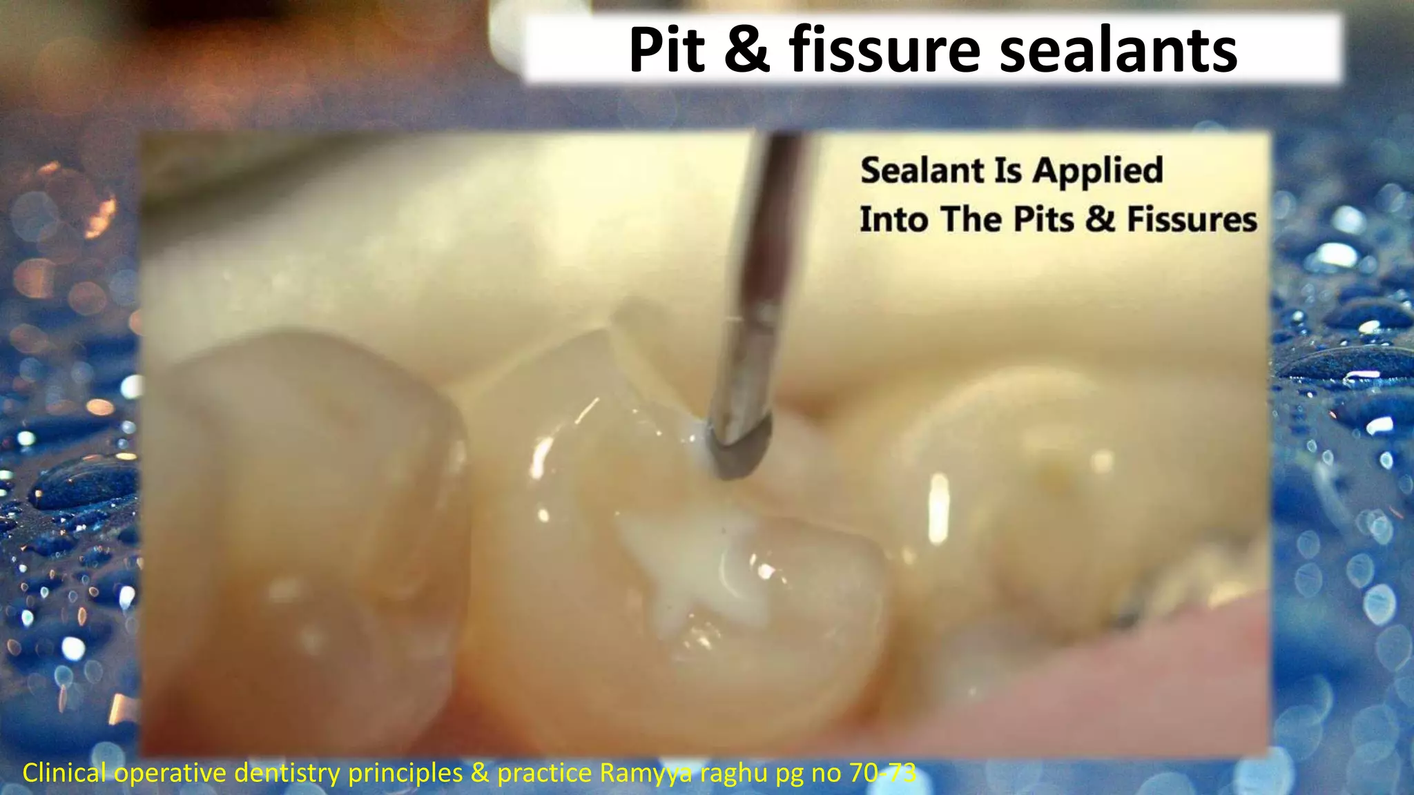Diagnosis & treatment of Dental caries | PPTX