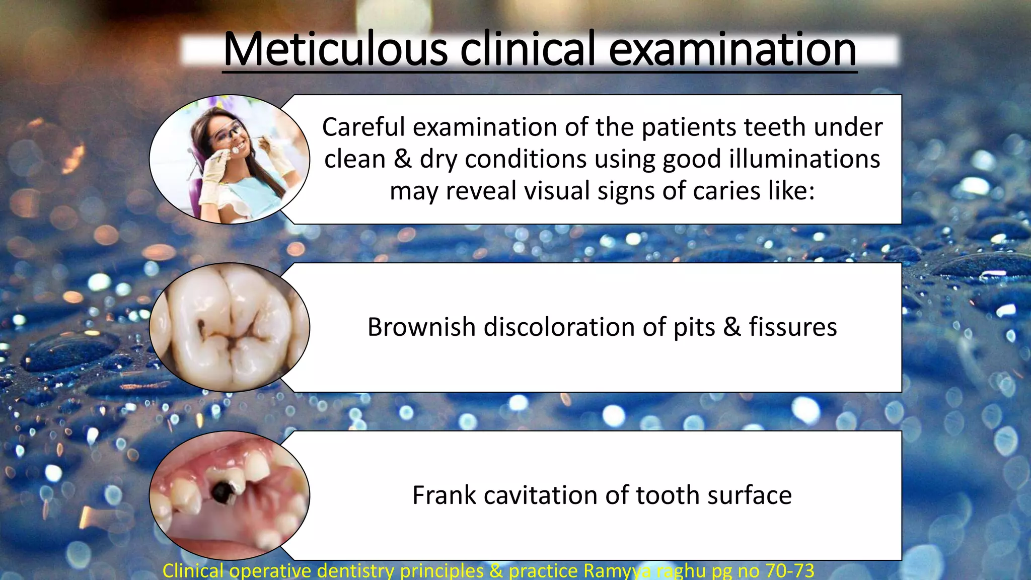 Diagnosis & treatment of Dental caries | PPTX