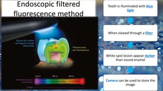 Diagnosis & treatment of Dental caries | PPTX