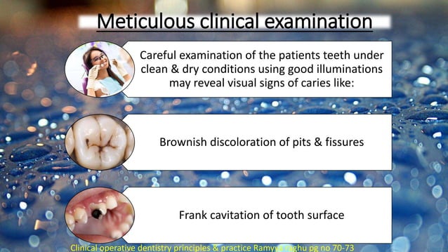 Diagnosis & treatment of Dental caries | PPTX