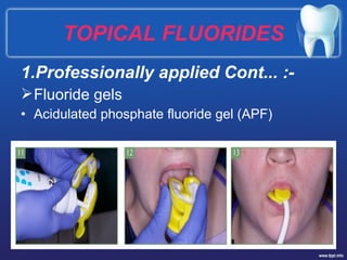 Prevention of dental caries | PPT