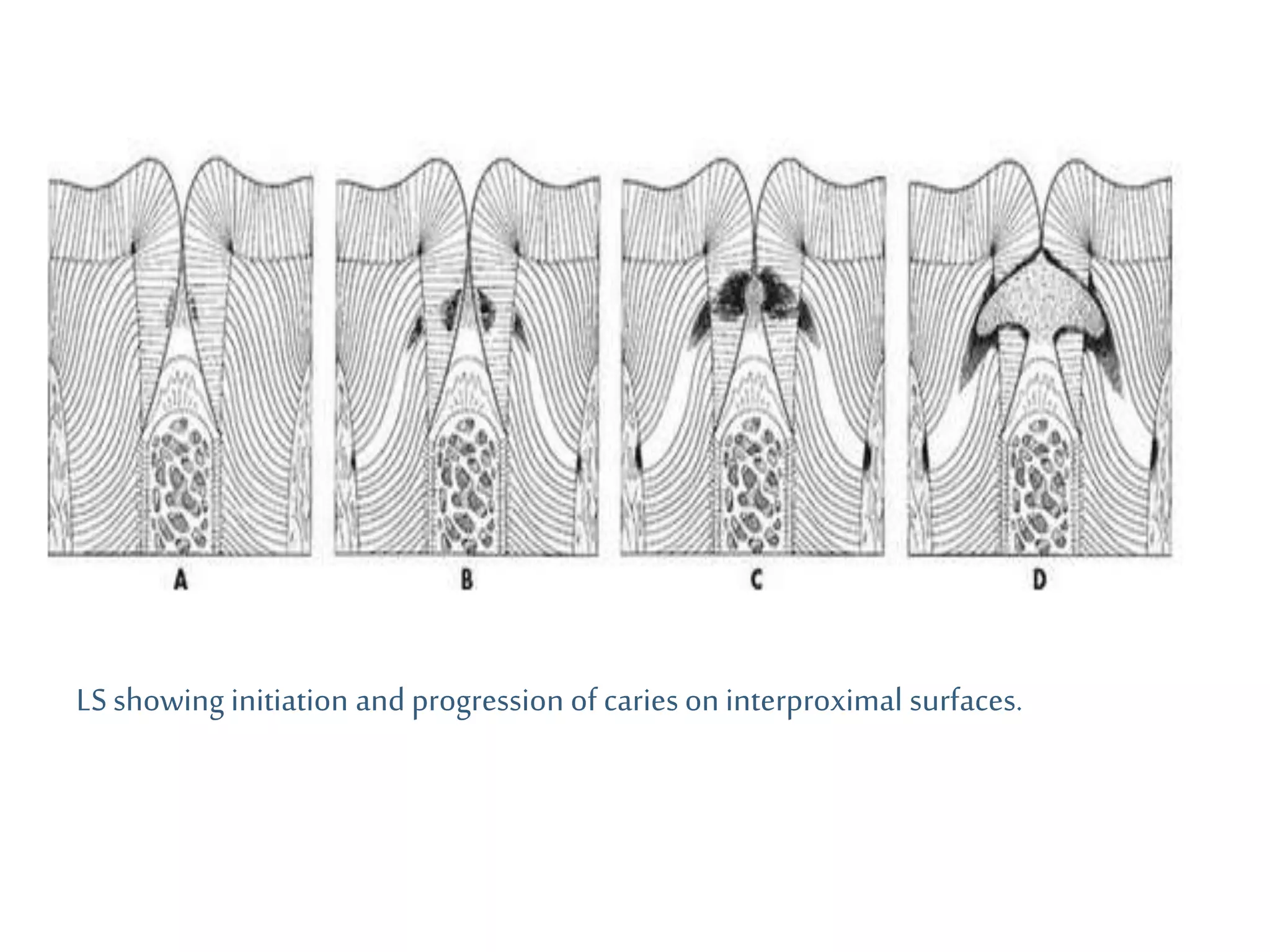 Dental caries ppt | PPTX