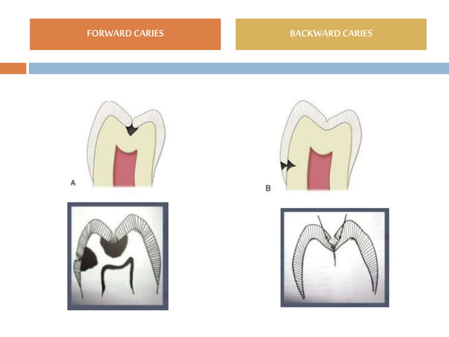 Dental caries ppt | PPTX
